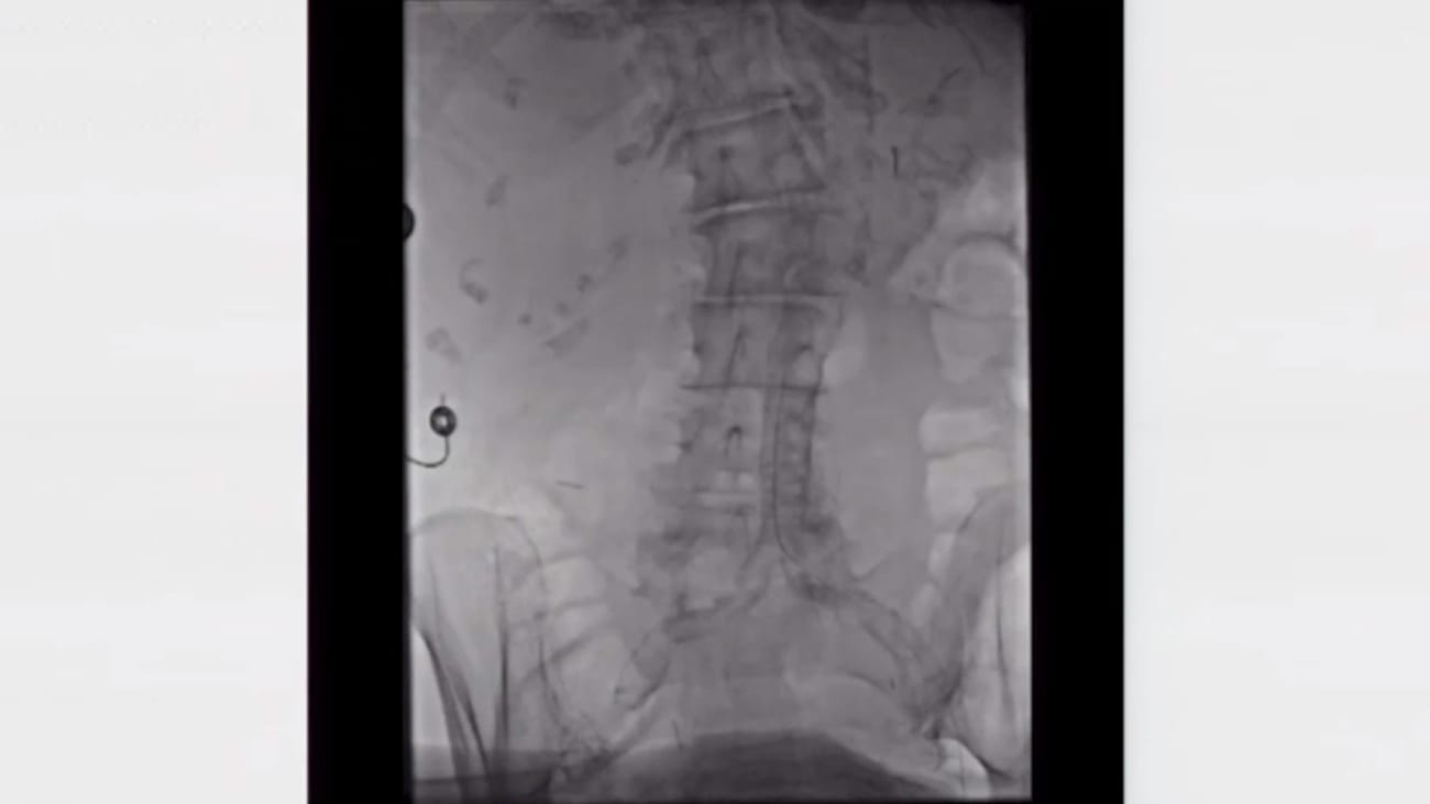 Catheter Skills for the Cardiac Surgeon: Catheters, Wire, Approaches ...