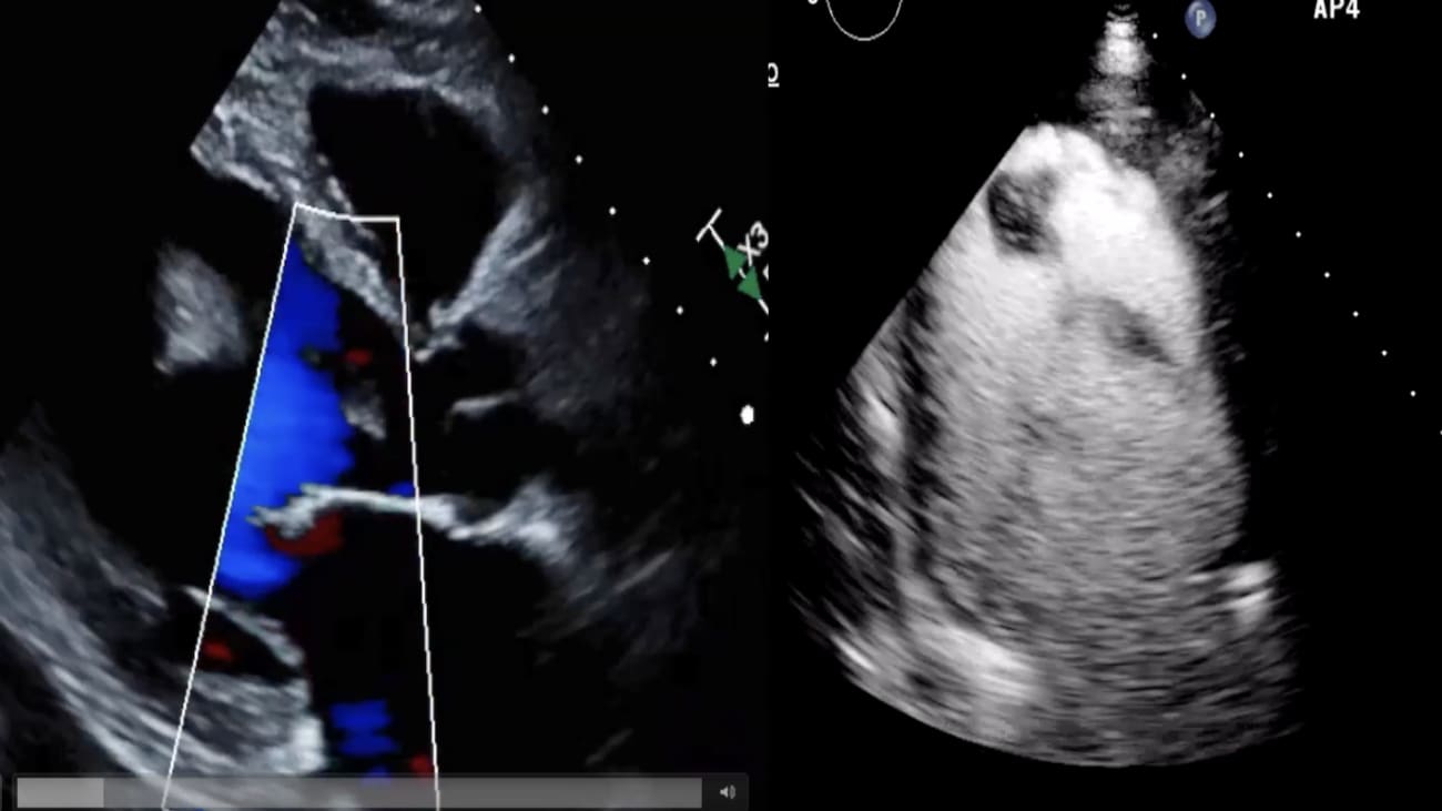 Case Study in Left Ventricular Thrombus - Sentara
