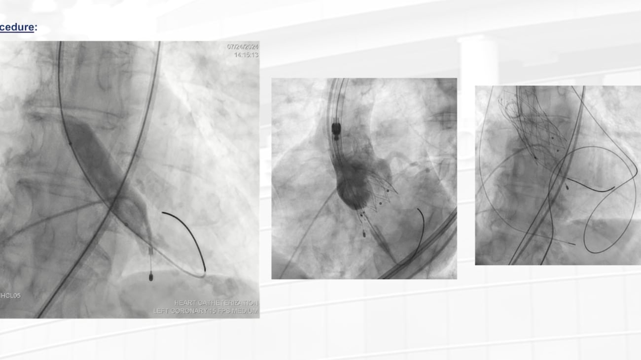 TAVR Basics: Fire Drill Overview #1: Pericardial Tamponade/Effusion ...
