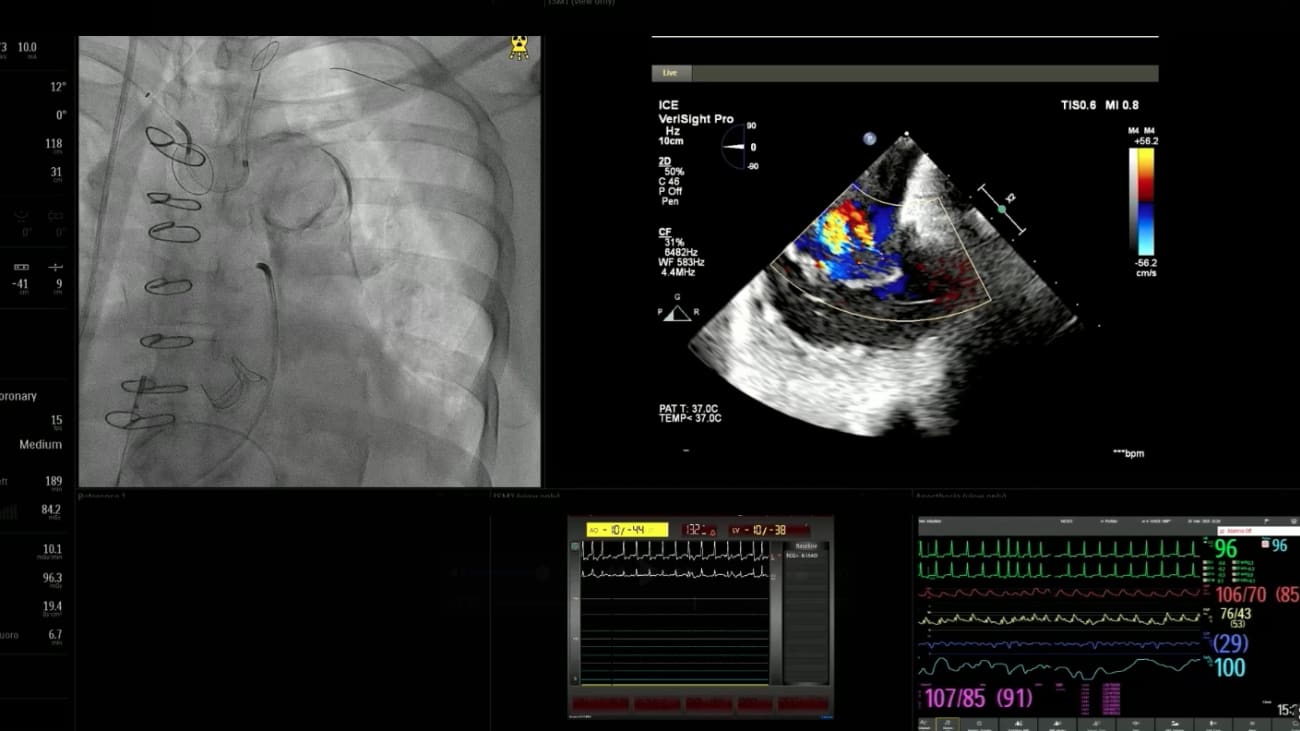 TAVR in High-Risk SAVR Patient - Sentara