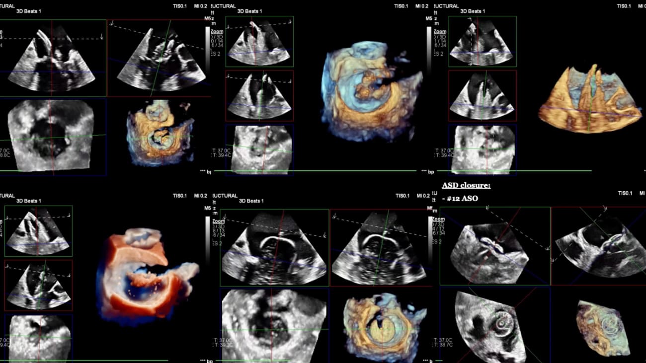 Current State of Transcatheter Mitral Valve Therapies: The Common ...