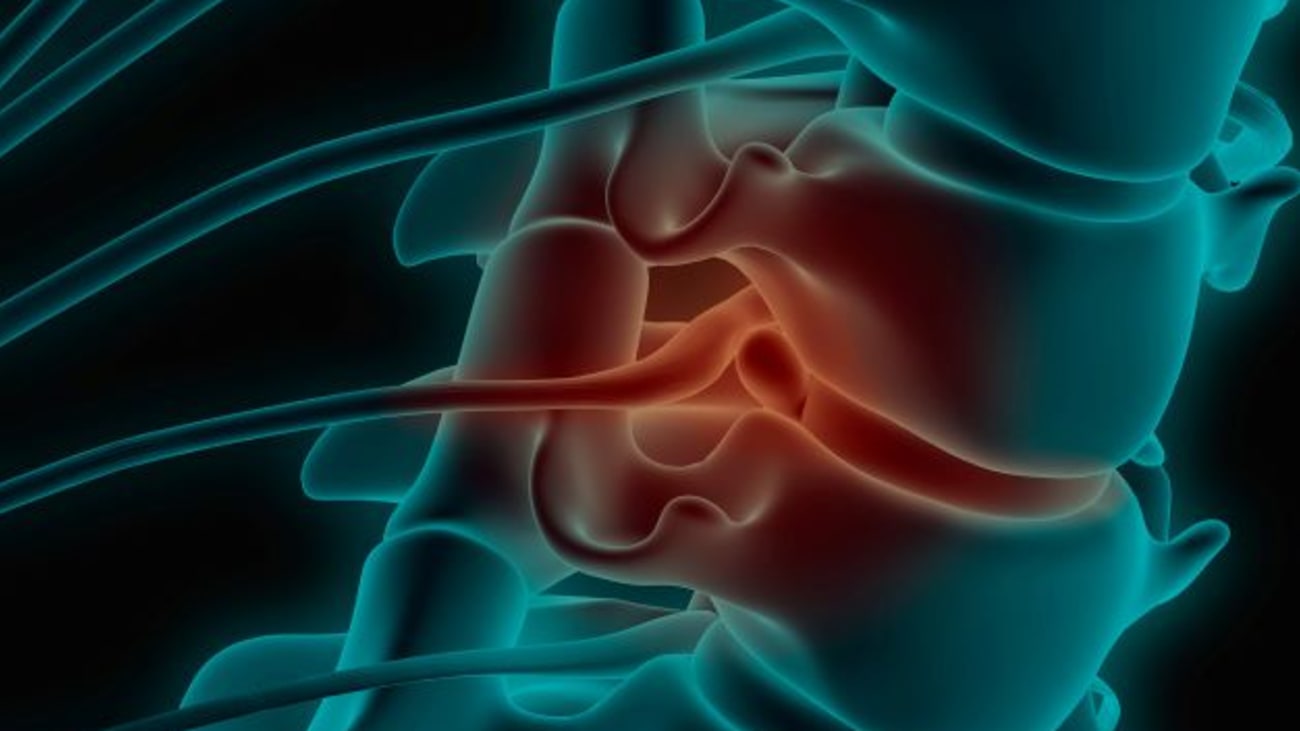 Motion Preservation Surgical Options in the Lumbar Spine - Sentara