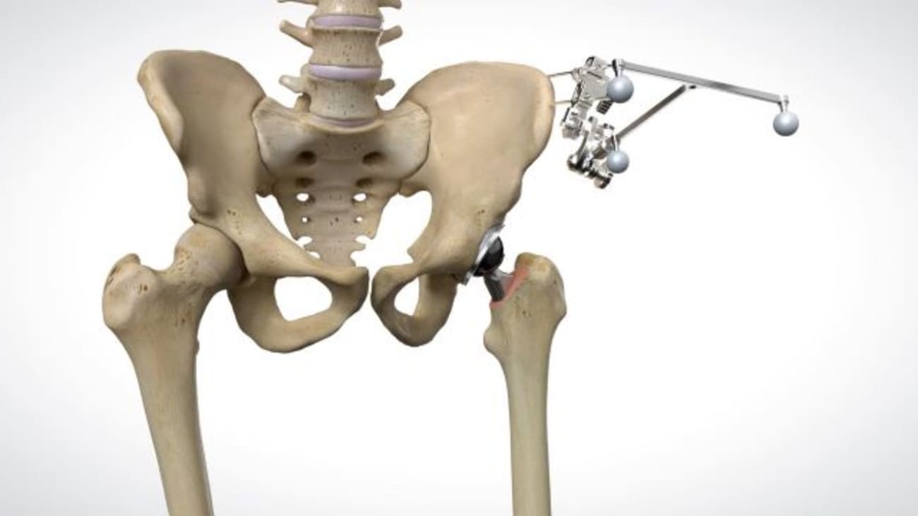 RI.HIP Animation - Smith & Nephew