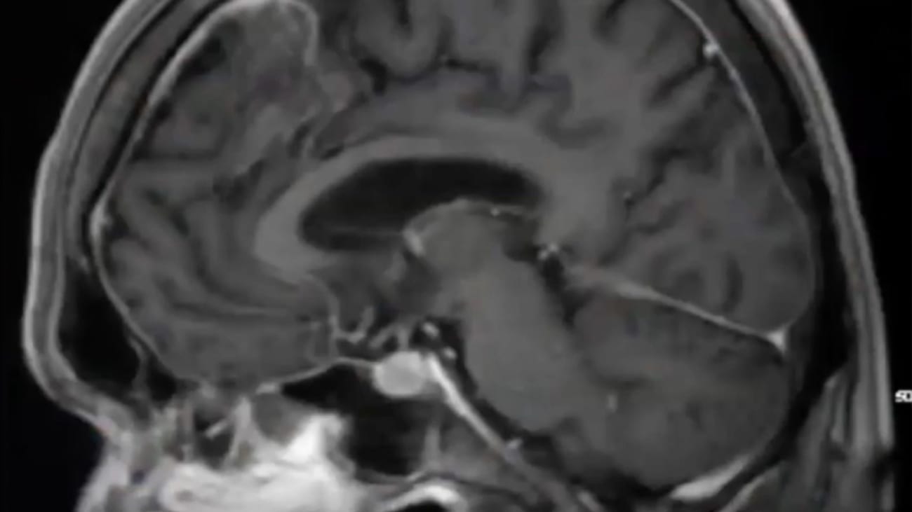 Neurosurgical Conditions on Adult MRI of the Brain - BroadcastMed