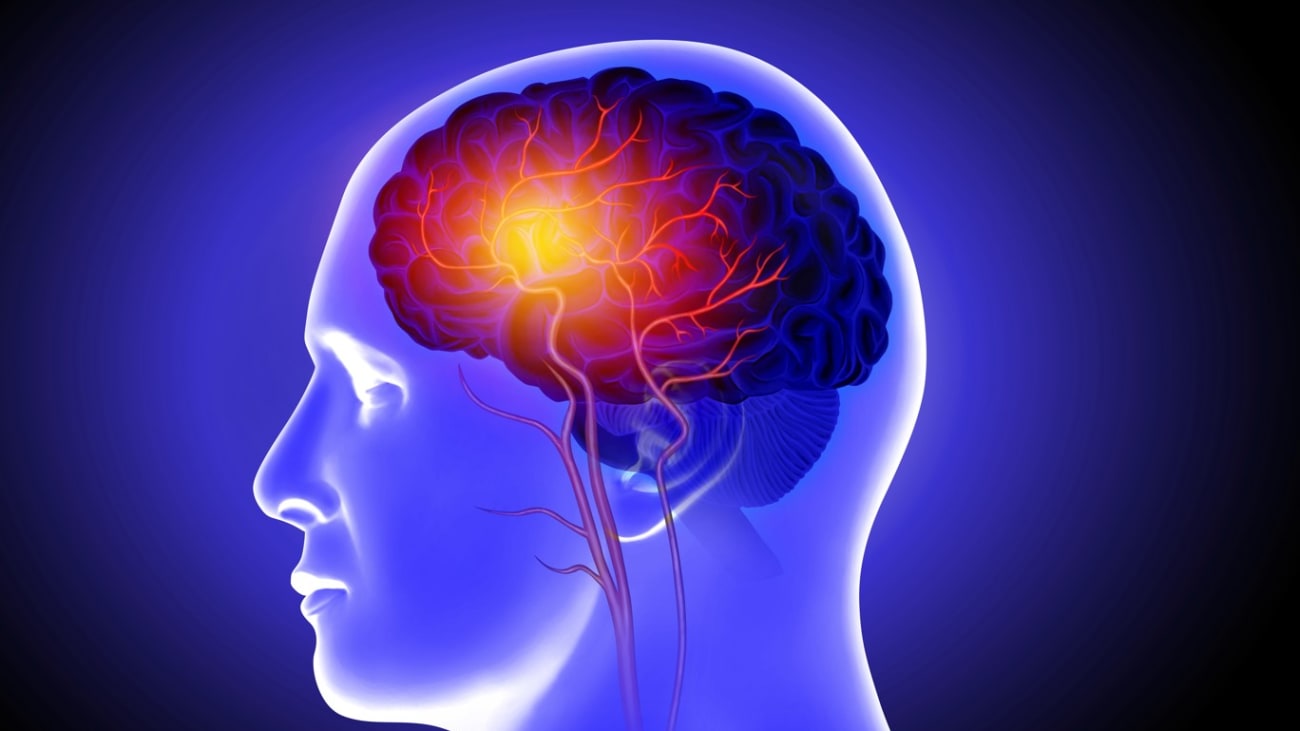 Brain Aneurysms: What Primary Care Providers Need to Know - UCSF ...
