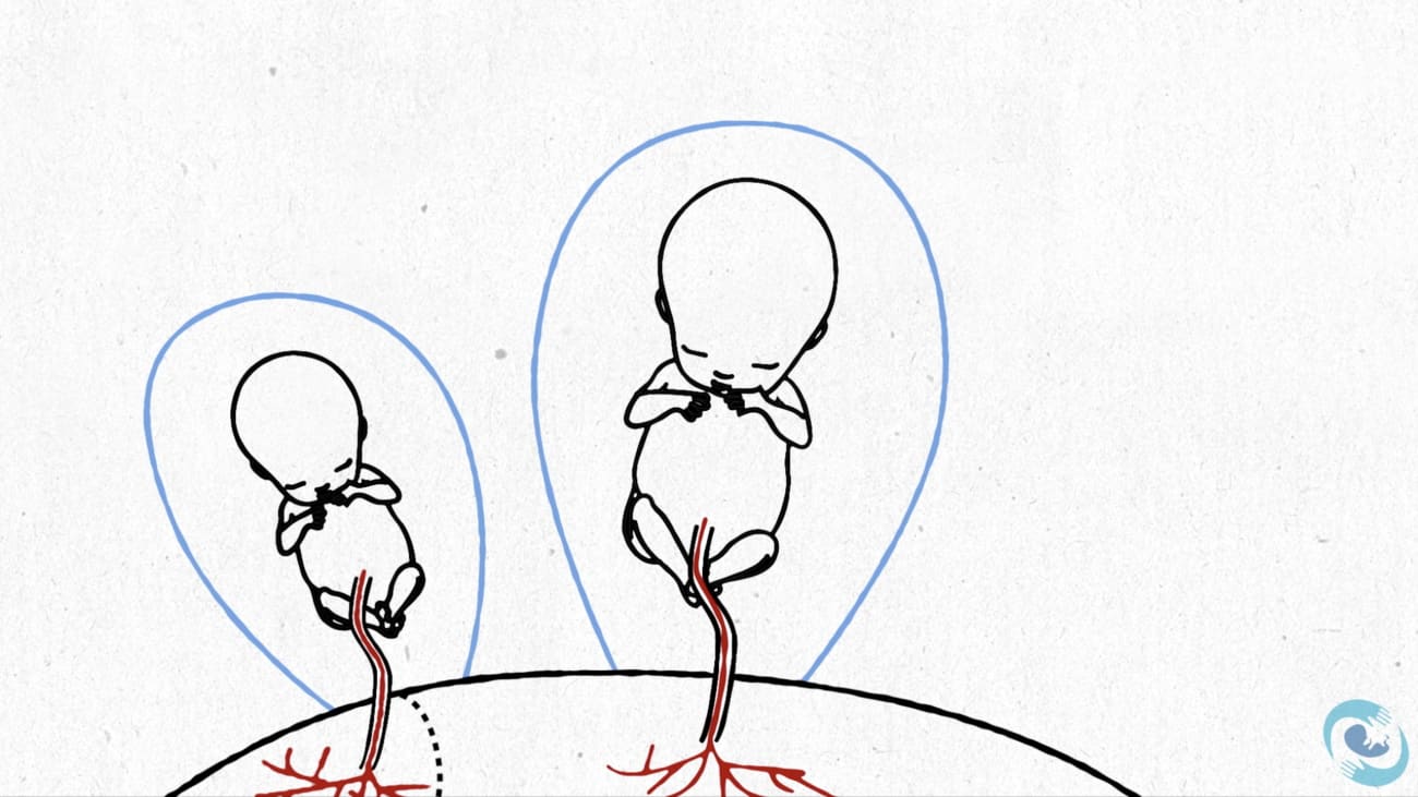 Unequal Placental Sharing - UCSF Pediatrics