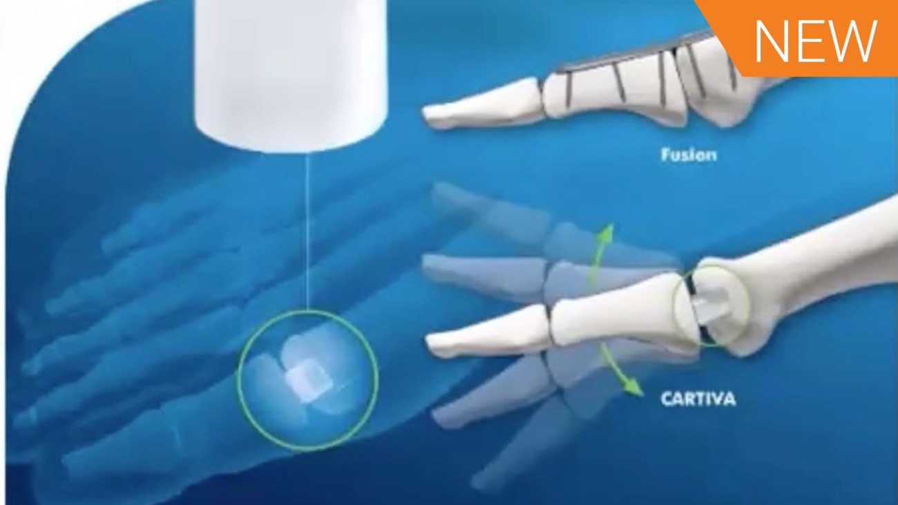 Surgical Treatment of Hallux Rigidus: Arthroplasty featuring CARTIVA ...