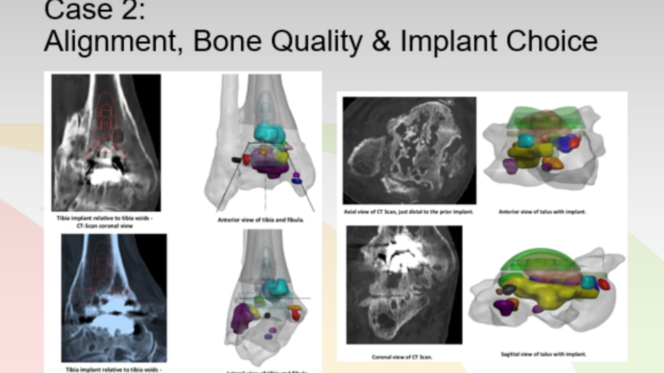 Revision Total Ankle Arthroplasty with PROPHECY[010807] - VLC