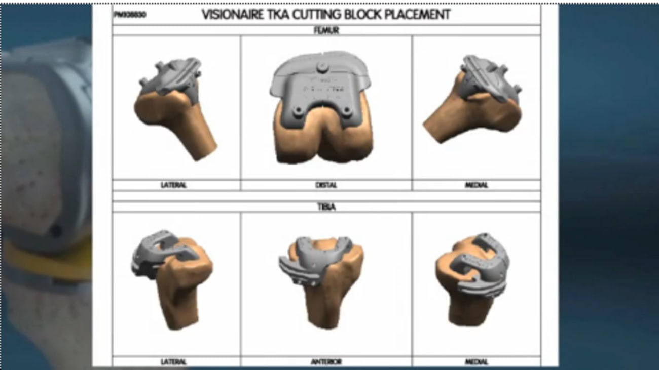 VISIONAIRE™ Technology - Benefits of Plan - Smith & Nephew