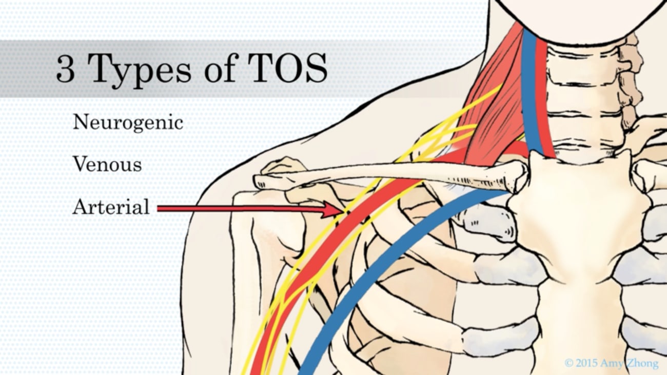 Nerve Block Treatment for Thoracic Outlet Syndrome (TOS) - Johns ...