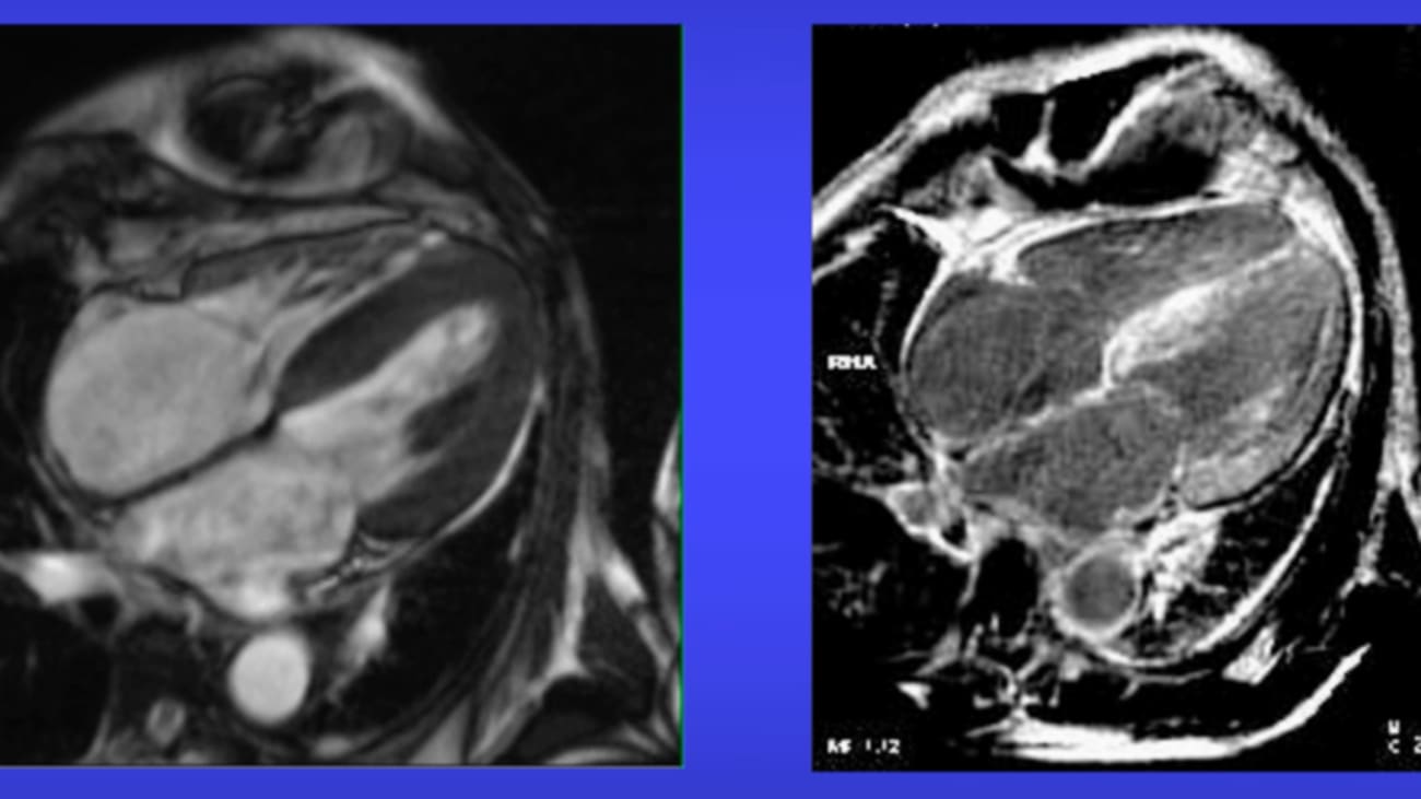 Molecular Imaging of Cardiomyopathy: Beyond Viable Myocardium Detection ...