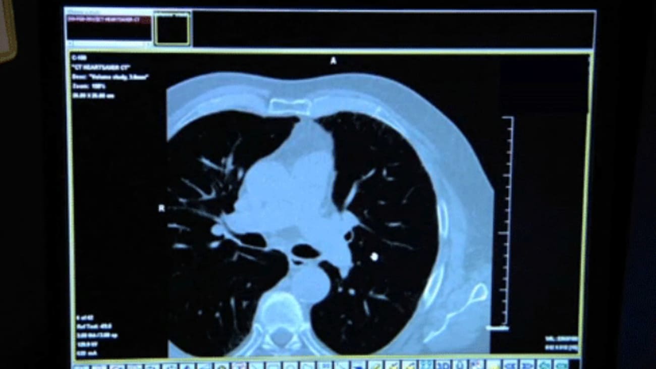 Review of Heartsaver CT Scan With Severe Blockage - What the Doctors ...