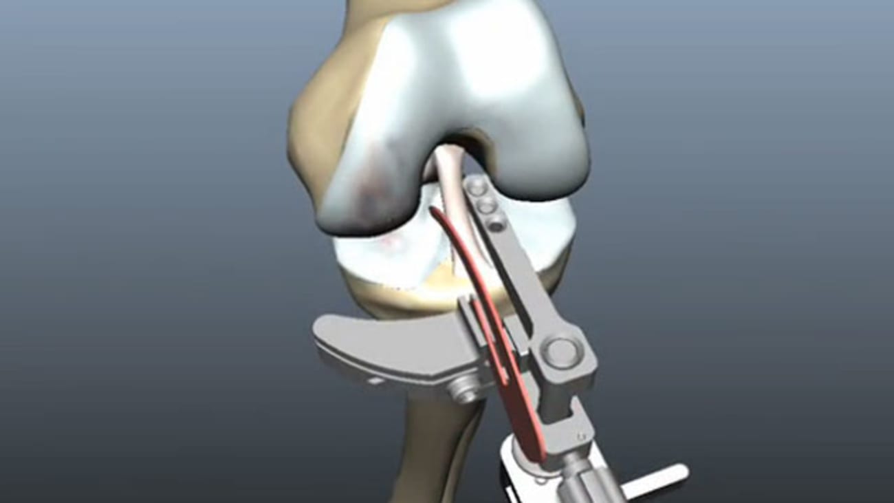 JOURNEY UNI Surgical Animation - Smith & Nephew