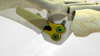 MINI MAXLOCK EXTREME™ ISO Plate Surgical Technique [ORTHO-804-026] - VLC