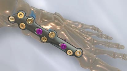 SALVATION™ EX-FIX Pilon Fracture Animation [015218] - BroadcastMed