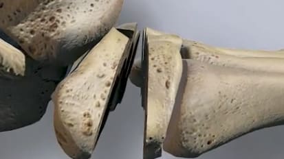 SALVATION™ EX-FIX Pilon Fracture Animation [015218] - BroadcastMed