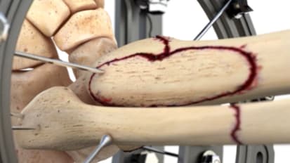 SALVATION™ External Fixation Frame Modification Five-Eighths Ring ...