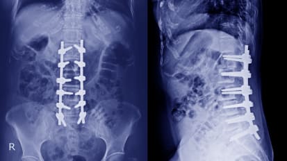 Complex Spine Surgery: Secrets of Successful Closure - UCSF MedConnection