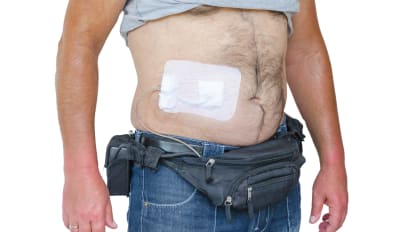 Left Ventricular Assist Device (LVAD) - Cardiology Procedures ...