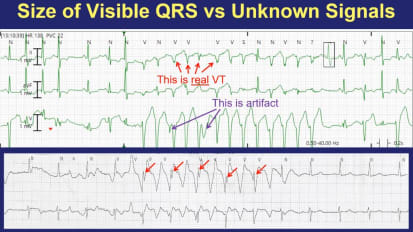 Telemetry Tips Part 1: Atrial Flutter and Atrial Tachycardia - BroadcastMed