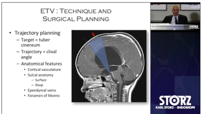 Endoscopic Third Ventriculostomy (ETV) Procedure - BroadcastMed