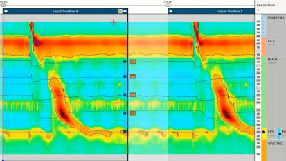 Esophageal Manometry - Diversatek University