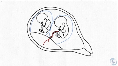 The Difference Between Dichorionic and Monochorionic Twins - UCSF ...