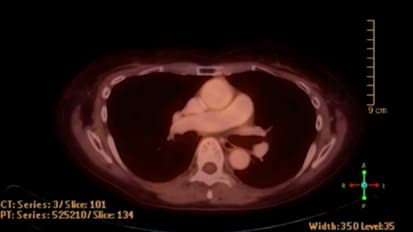 Cancer Immunotherapy: Promise and Pitfalls - UCSF MedConnection