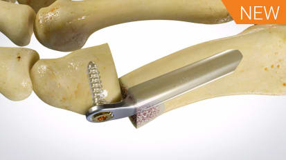 PROstep™ Minimally Invasive Surgery - VLC