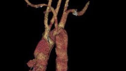 Mayo Clinic's approach to anomalous coronary artery unroofing - Mayo Clinic