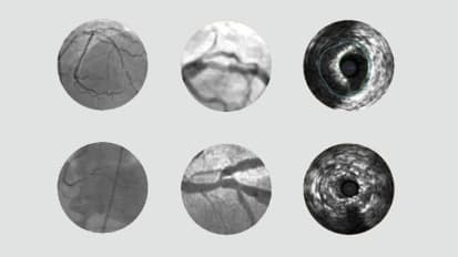 IVUS - Coronary - Philips Image Guided Therapy Devices Academy