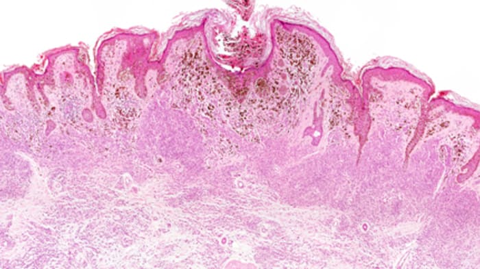 Mohs Micrographic Surgery - Physician's Channel - Mount Sinai New York