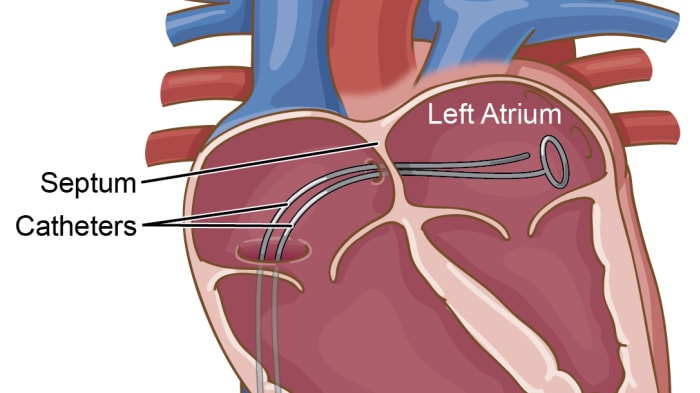 Catheter Ablation of Atrial Fibrillation – Update for 2013 - Physician ...