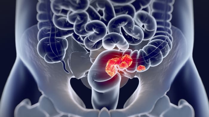 Rectal Cancer Update: Short Course Radiation, TNT, NOM, W&W... What ...