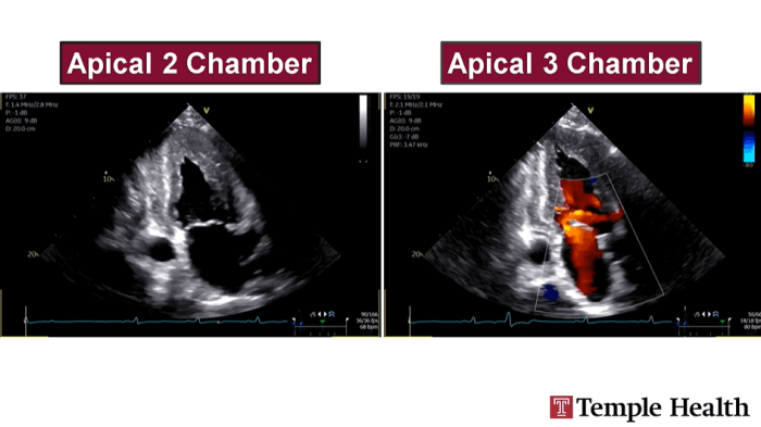 Diagnosing the Apical Variant of Hypertrophic Cardiomyopathy - Temple ...