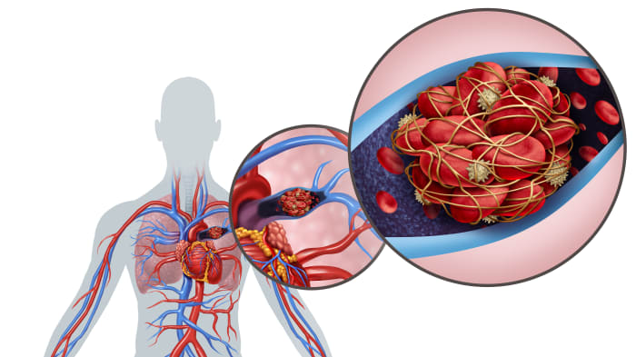 Standardizing the Pulmonary Embolism care with Pulmonary Embolism ...