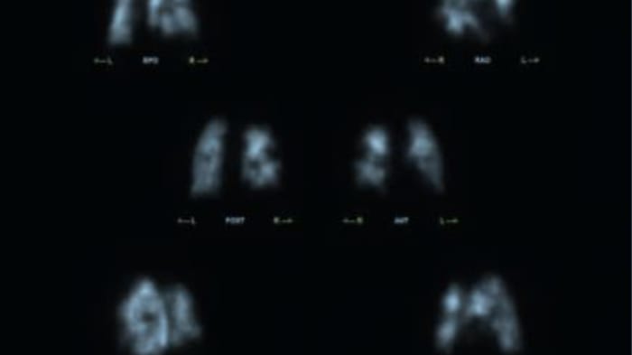 Advanced Diagnosis and Therapy for Chronic Thromboembolic Pulmonary ...