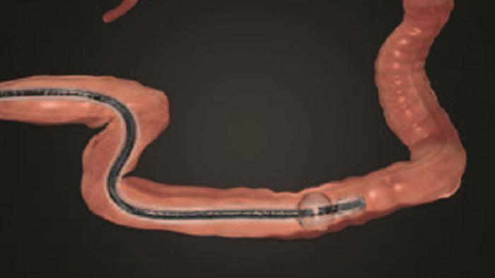 Colon Straightening Technique - Lumendi