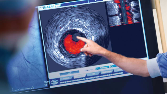 ChromaFlo Imaging - Philips Image Guided Therapy Devices Academy