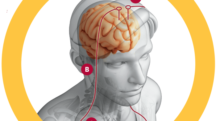 Deep brain stimulation - Keck Medicine of USC