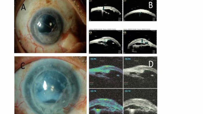 Eye Plaque Radiation Therapy Preserves the Sight of Patients With ...