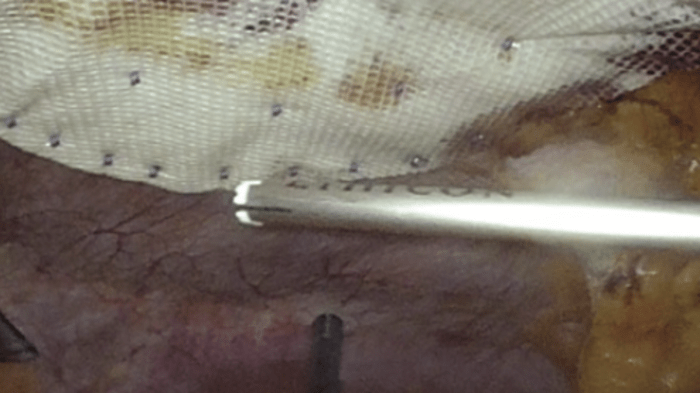 Expert Review: Clinical experience with GORE ® SYNECOR Intraperitoneal ...