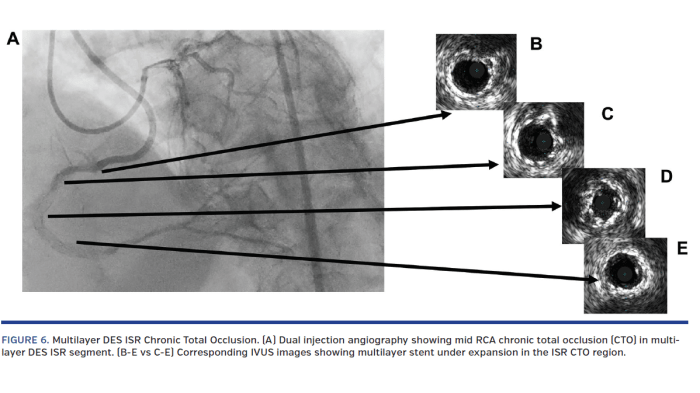 Coronary ISR An Algorithmic Approach to Diagnosis and Treatment ...