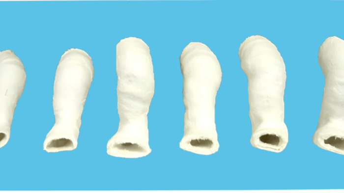 Common Errors in the Management of Idiopathic Clubfeet Using the ...