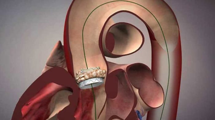 Device test may determine near future of aortic-valve repair - BroadcastMed