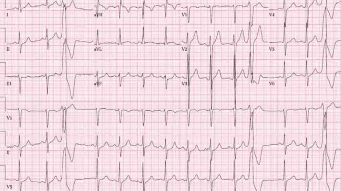 Workup of Palpitations - Sentara