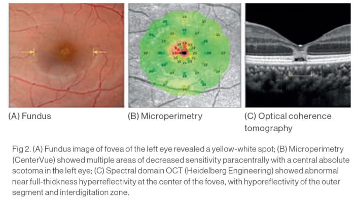 An Unprecedented Look at Acute Solar Retinopathy - Physician's Channel ...