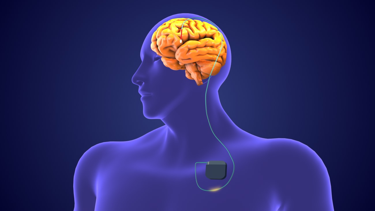 Case Study: Asleep Deep Brain Stimulation Brings Relief to Patients ...