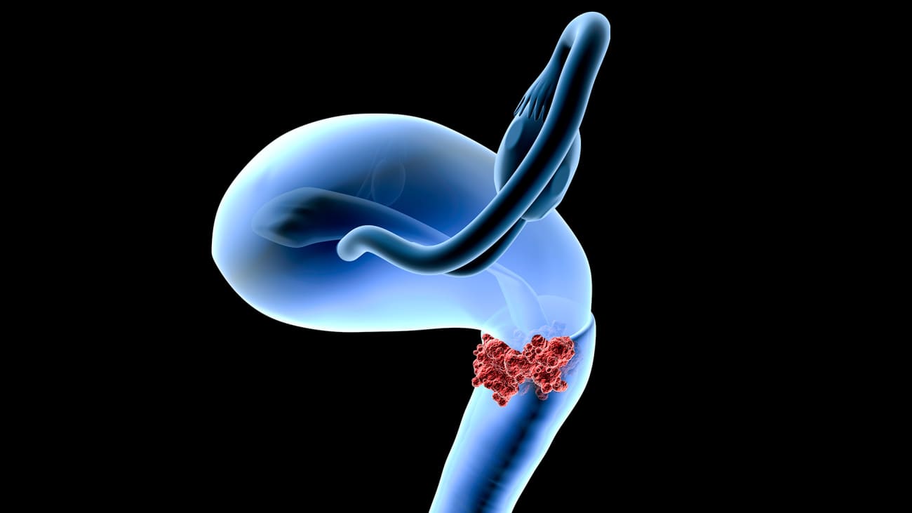 Brachytherapy Improves Outcomes for Cervical Cancer Patients - UCSF ...