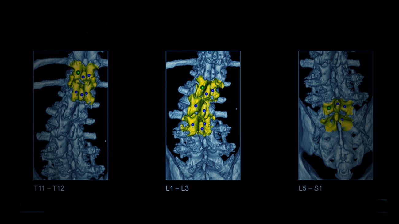 Efficient, Radiation-Free Navigation: Ushering in a New Era of Spine ...